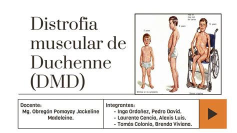 Distrofia Muscular De Duchenne Viviana Tomas Udocz