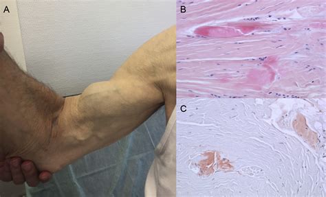 Diagnosis And Treatment Of Transthyretin Cardiac Amyloidosis Progress