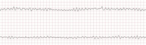 Sudden Cardiac Arrest Case 3 The Cardiovascular