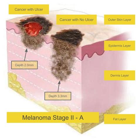 Melanoma