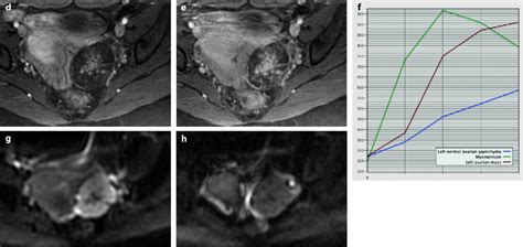 Sex Cord Stromal Tumors Radiology Key