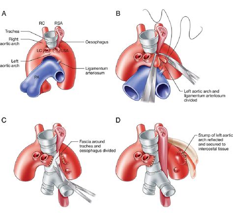 Aortic Ring Surgery