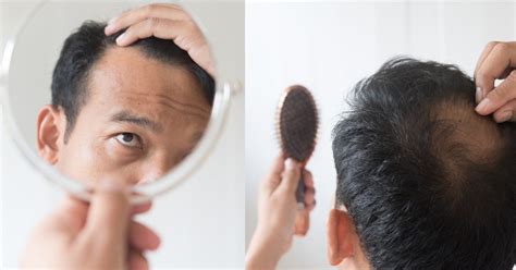Hair Loss Why It Occurs Treatment And How To Prevent It