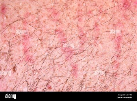 Dermatographic Vascular Urticaria Close Up Of A Dermatographic Skin Dermatographic Vascular Urticaria Close Up Of A Dermatographic Skin