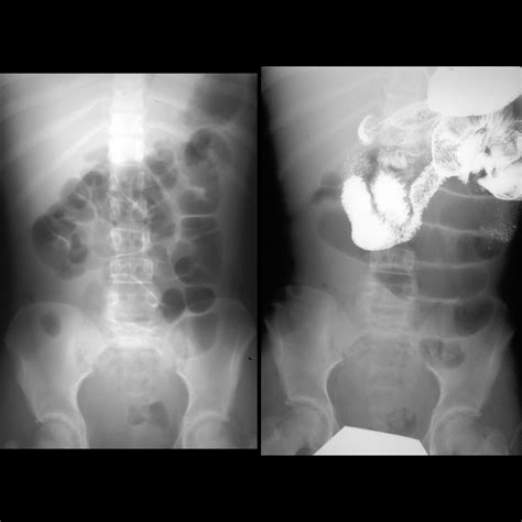 Pediatric Small Bowel Obstruction Pediatric Radiology Reference Article Pediatric Imaging