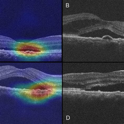 A Representative Case Of Persistent Csc With Oct Angiography The Left