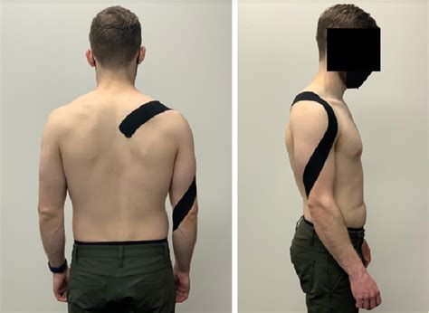 Novel Kinesiology Taping Technique To Promote Humeral Internal
