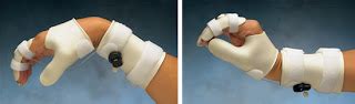 OCCUPATIONAL THERAPY SPLINTING Variety Of Splint