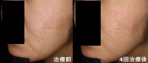 コラーゲンピールで透明感のある肌へ ニキビ治療の実績多数｜セイコメディカル福岡院 美容皮膚科 美容外科
