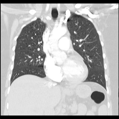 Radiopaedia Case Centrilobular Emphysema Id 46611 Study 51075 Nc