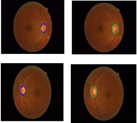 Table 1 From An Efficient Automatic Method Of Optic Disc Segmentation