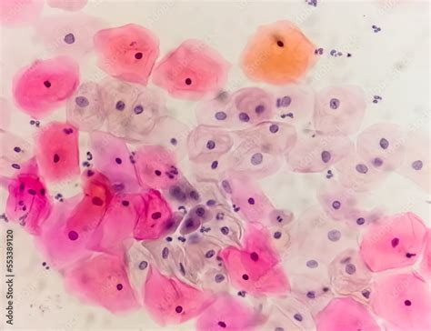 Poster Paps Smear Under Microscopy Showing Inflammatory Smear With Hpv