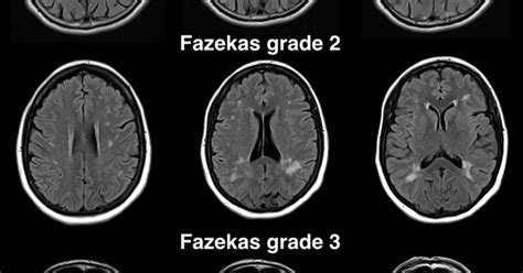 The Fazekas Scale Is Used To Simply Quantify The Amount Of White Matter