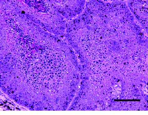 Photomicrograph Of Epidermis Surrounding An In Situ Squamous Cell