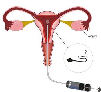 Artificial Insemination Hormones In Fertility Drugs Biology Notes For Igcse