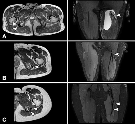 Mri For Hamstring Injury