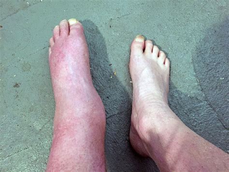 Dear Doctor What Can I Do About Chronic Edema Silive