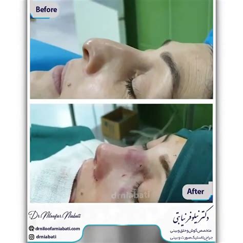 قبل و بعد از جراحی بینی