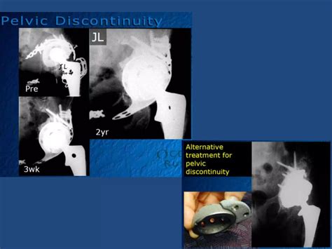 Acetabular Defects Pptx