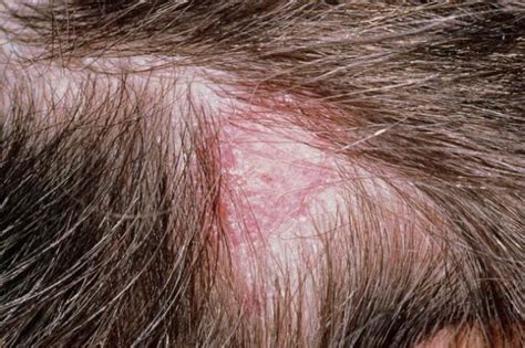 Natural Treatments To Get Rid Of Scalp Fungus LAVYON