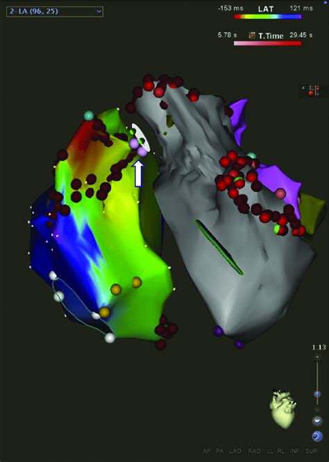 Carto Map Biosense Webster Diamond Bar Ca Of Right Atrium And Left Download Scientific