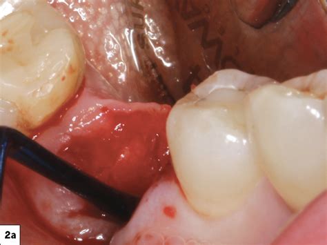 Socket Grafting And Implant Placement A Simplified Approach