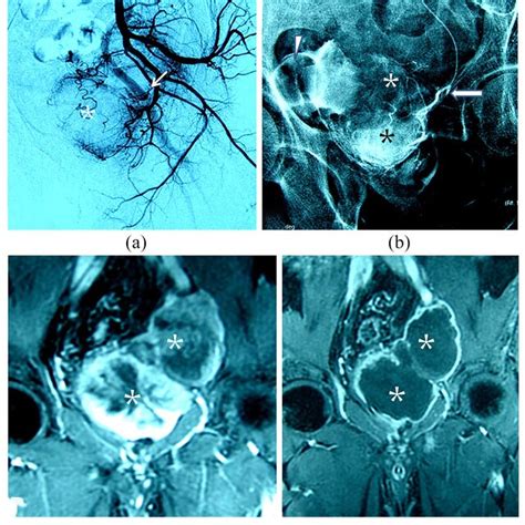 A 46 Year Old Man Presented With Progressive Obstructive Voiding