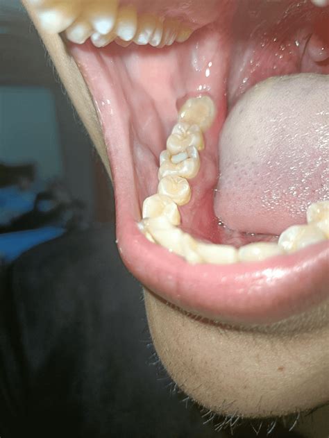 What To Do If Dental Abscess Ruptured Raskdentists