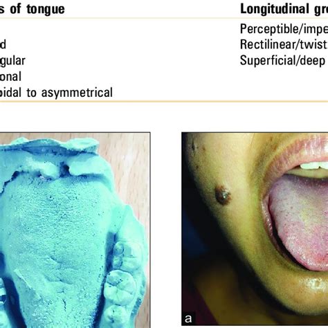 Classification Of Tongue Features By Stefanescu Et Al Download