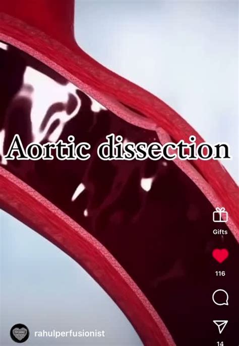 Simin Nava On Linkedin Great Visual On Aortic Disection