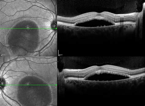 Serous Macular Detachment In Best Disease Retinara