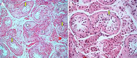 Photo Histogram From A Testicular Biopsy Showing Hyalinized