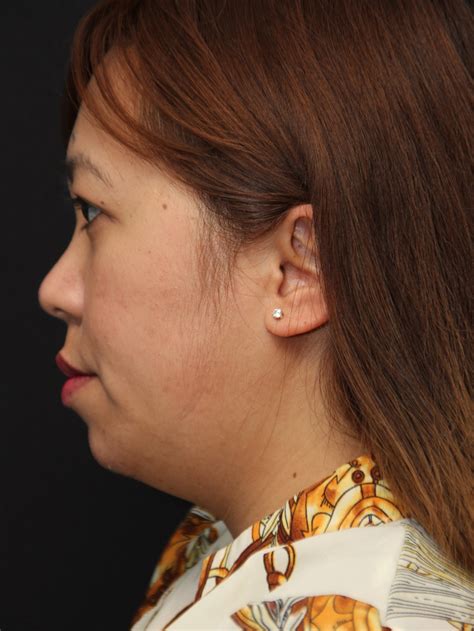 Chin Implants Jan 2024 Solomon Facial Plastic