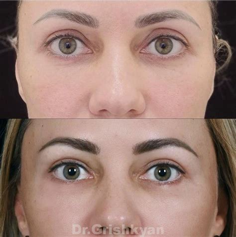Повторная блефаропластика век цена неудачная пластика век