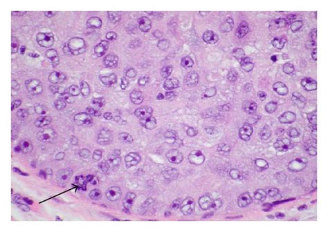 High Grade Dcis With Atypical Pleomorphic Nuclei And Prominent Nucleoli