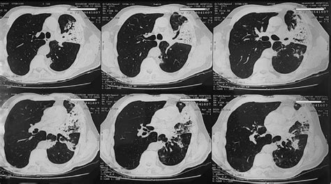 Segmental Consolidation With Centrilobular Nodular Infiltration And Download Scientific