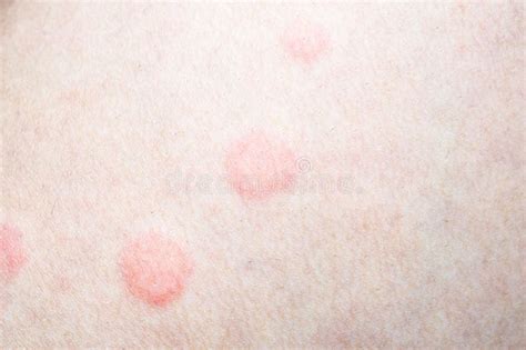 Skin Allergy Rash Dermatitis Texture Closeup Stock Image Image Of