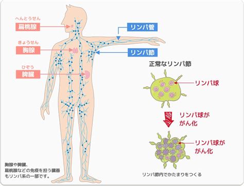 【医師監修】水素吸入は悪性リンパ腫の予防や治療に効果はある？