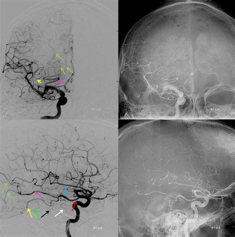 Posterior Cerebral Artery