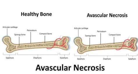 Osteonecrosis Avascular Necrosis Symptoms