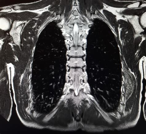 Mohamed Karem Elnaggar On Linkedin Elastofibroma Dorsi