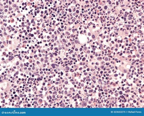 Chronic Myeloid Leukemia Bone Marrow Stock Image Image Of