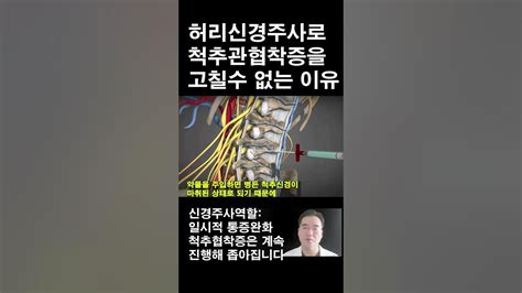 Shorts 척추관협착증때 허리신경주사로 고칠수 없는 이유신촌연세병원척추센터장신경외과김영우 양방향척추내시경 척추디스크탈출증