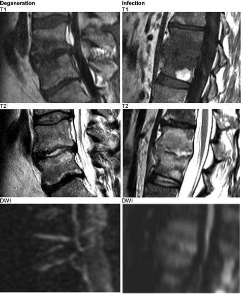 Diffusion Weighted Mri Claw Sign” Improves Differentiation Of