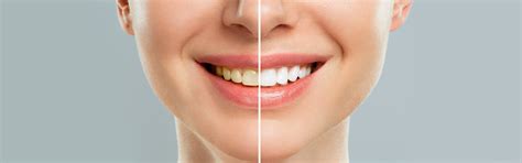Get Dazzling Teeth With Professional DIY Whitening Techniques Blog