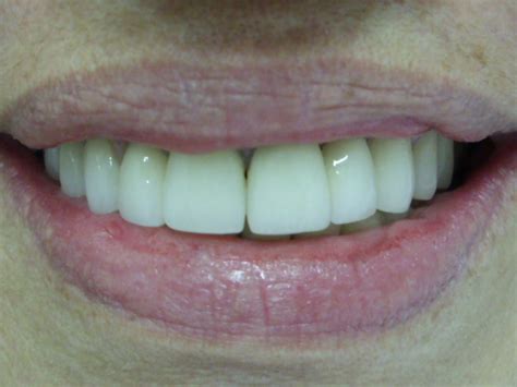 ORAL Odontologia Reabilitação Relato de Caso Clínico