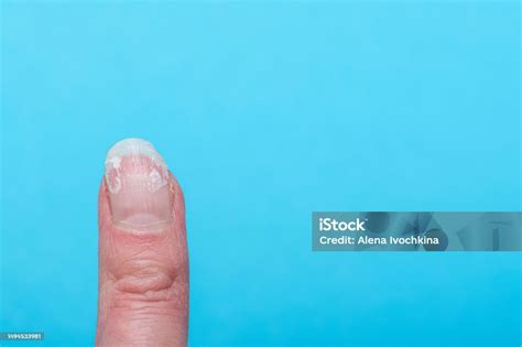 자란 큐티클과 손상된 네일 플레이트가 있는 매니큐어 없이 물고 부러진 손톱을 가진 여자의 손가락 갈고리 발톱에 대한 스톡 사진 및 기타 이미지 Istock