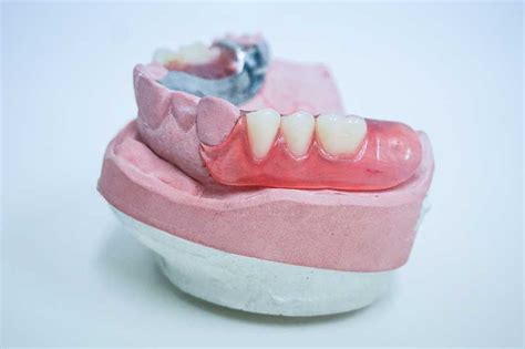 Chrome Dentures Tweed Heads Affordable Custom Metal Dentures