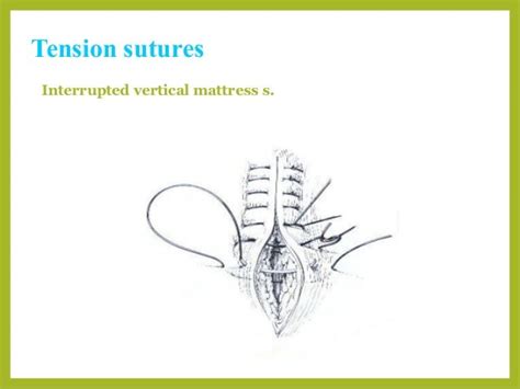 Basic Suture Patterns