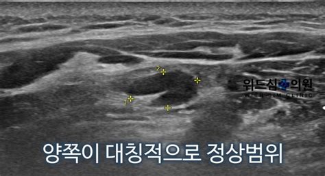 목 임파선 부었을 때 림프절 멍울 단순한 부음인지 정밀검사가 필요한 비대인지 잘 구분하기 이비인후과 전문의 조우진